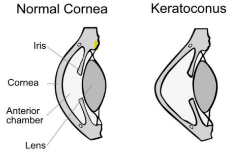 Keratoconus - Buckinghamshire Healthcare NHS Trust